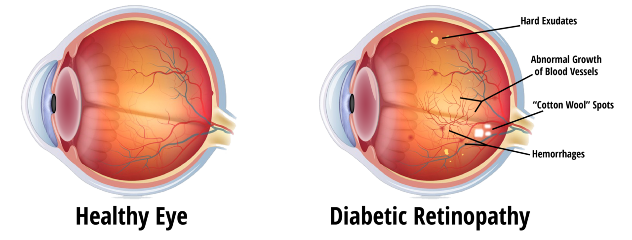 Diabetic eye diagnosis and treatment. Stop vision loss today!